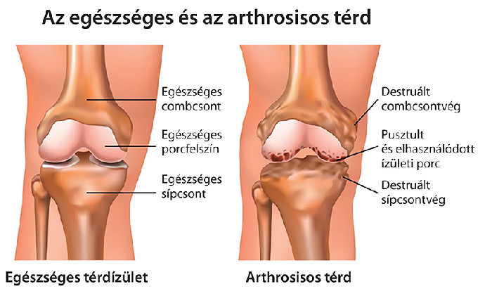 A porckopás (arthrosis) tünetei és kezelése :: Heves3praxis